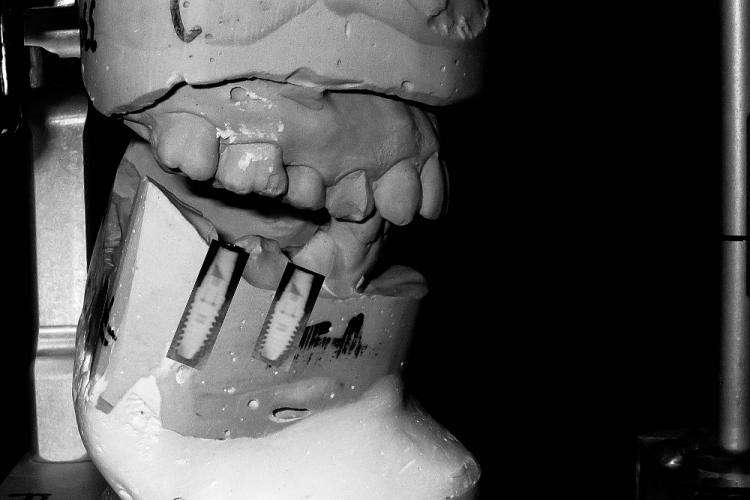 Dental News - The Virtual Facebow: A digital companion to implantology