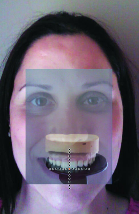 The Virtual Facebow: A digital companion to implantology