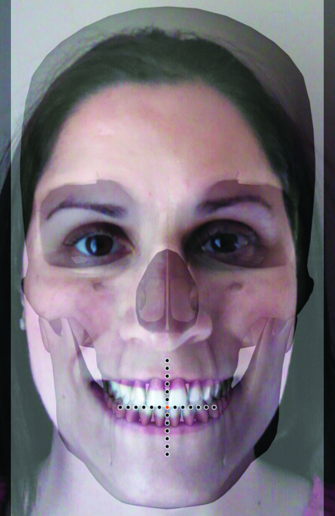 The Virtual Facebow: A digital companion to implantology