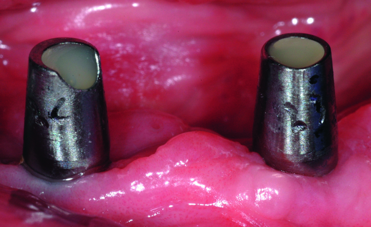 Dental News - Treatment options for the edentulous arch