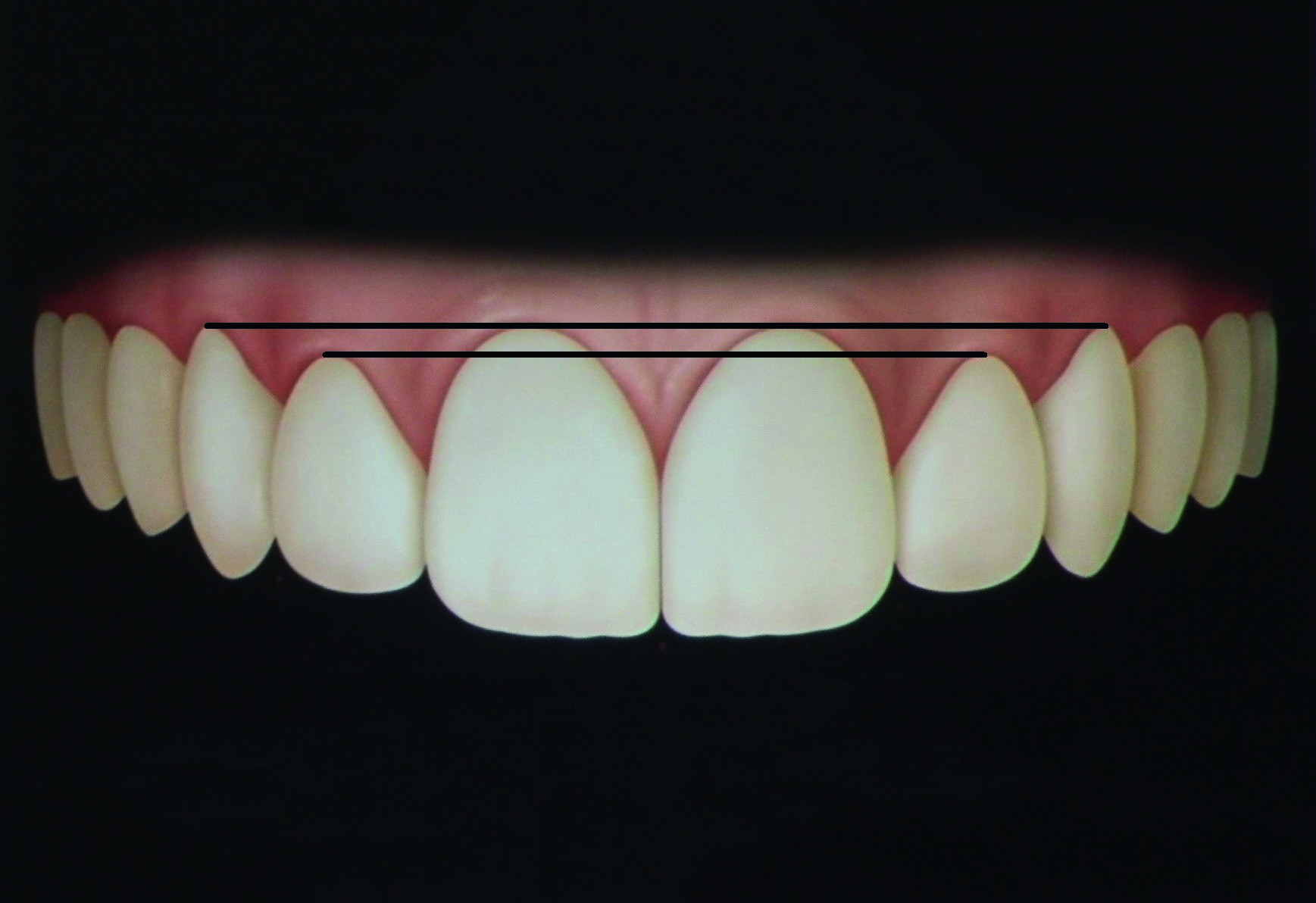Dental News - Orthodontic management of maxillary lateral incisors agenesis