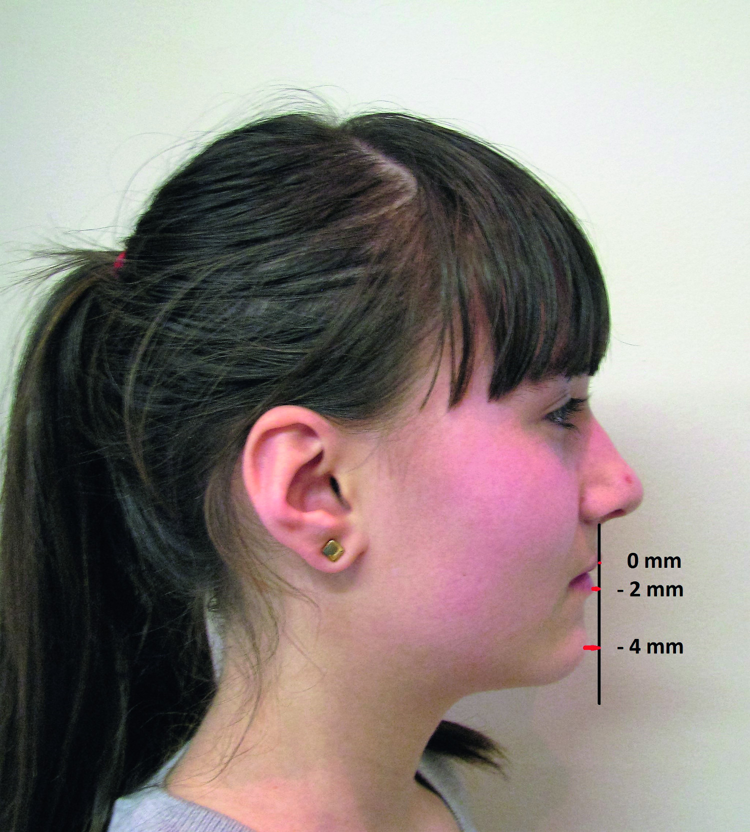 Dental News - Orthodontic management of maxillary lateral incisors agenesis