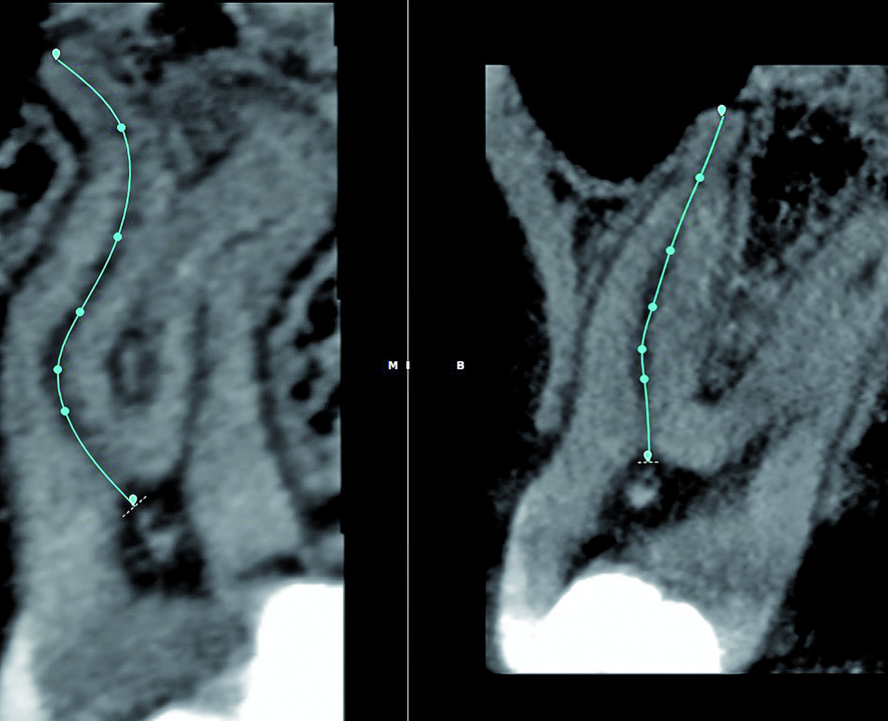 Dental News - 3D Endo Software, glide path management and WaveOne Gold