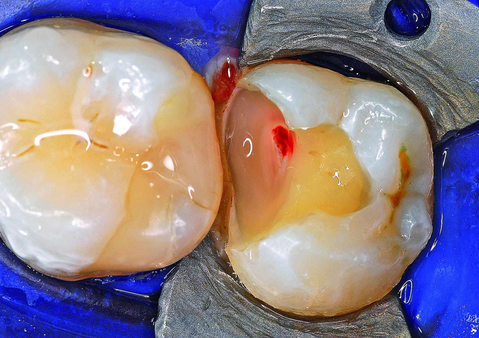 Dental News - 3D Endo Software, glide path management and WaveOne Gold