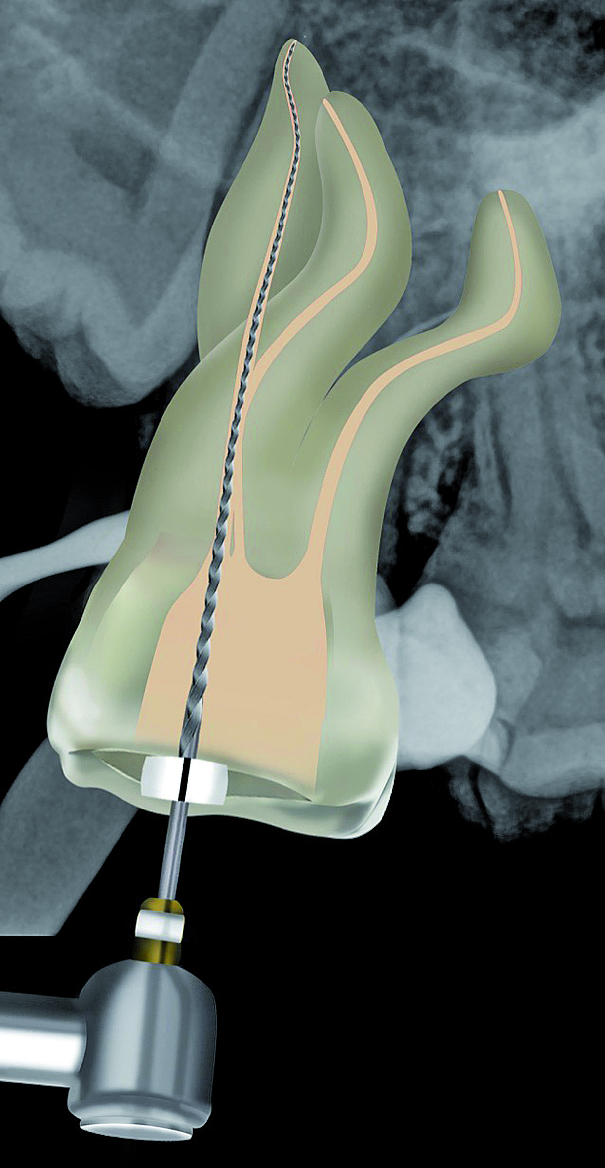 Dental News - 3D Endo Software, glide path management and WaveOne Gold