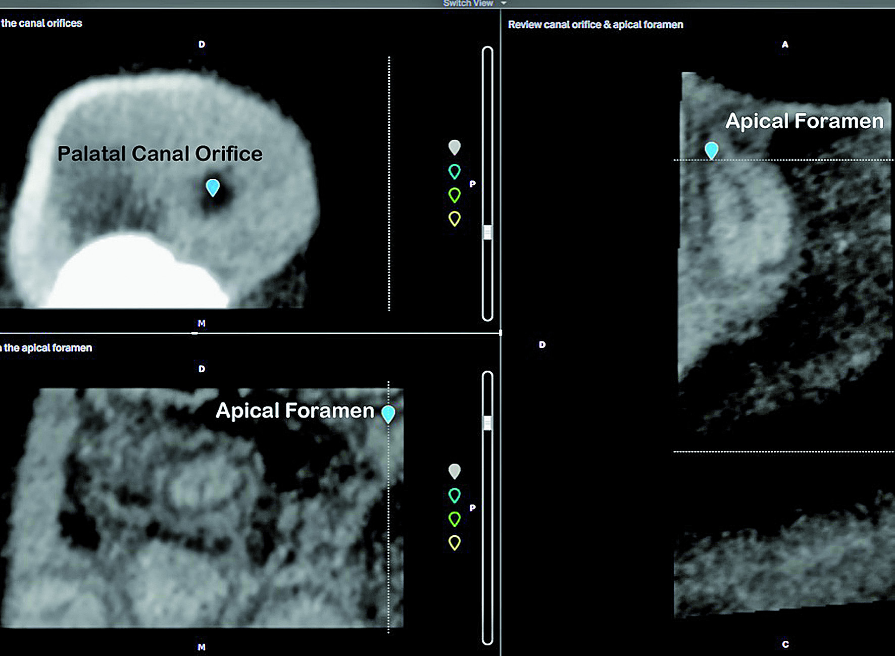 Dental News - 3D Endo Software, glide path management and WaveOne Gold