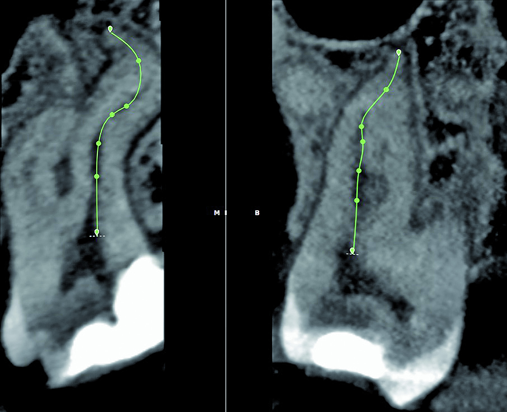 Dental News - 3D Endo Software, glide path management and WaveOne Gold