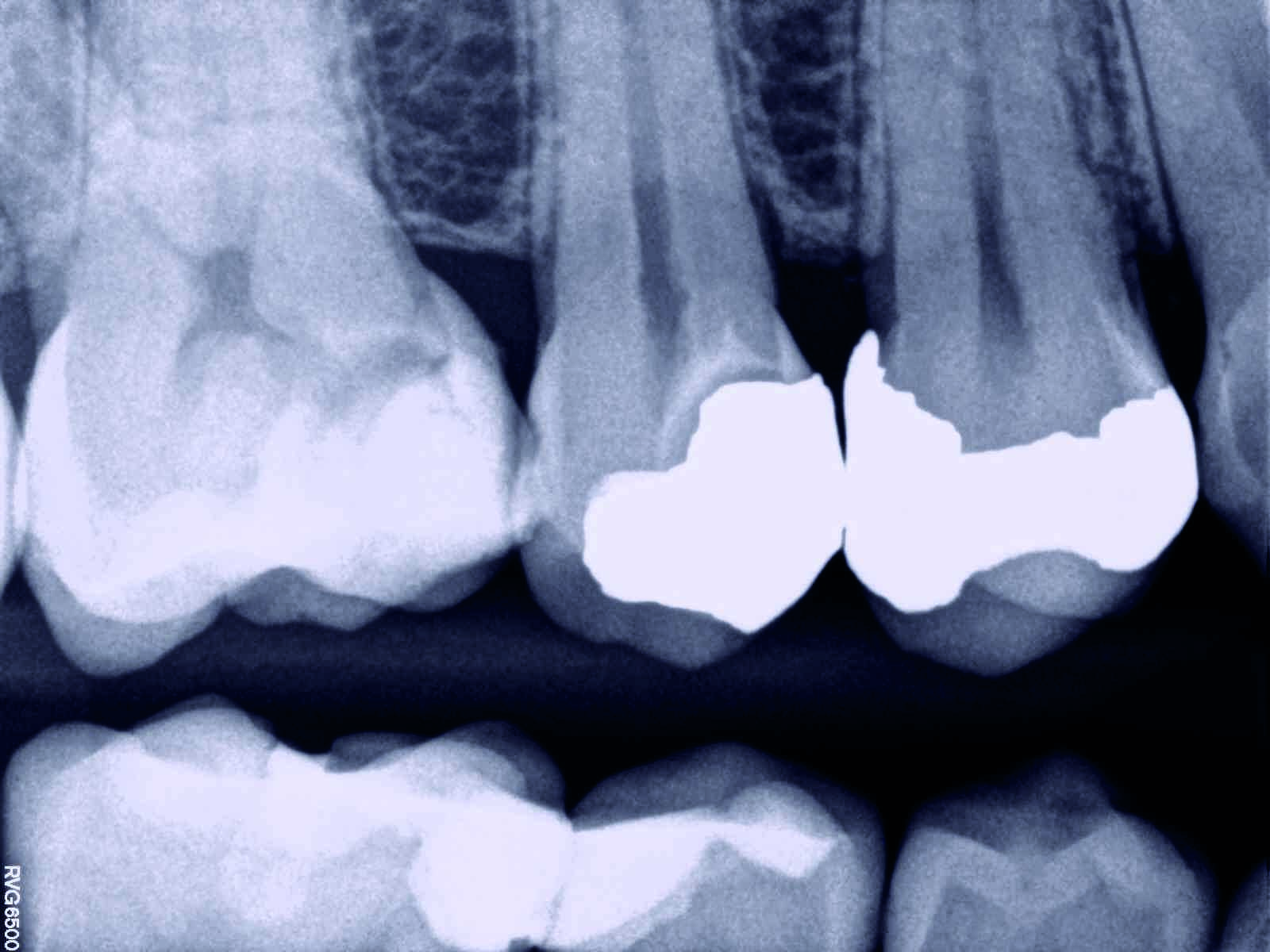 Direct pulp capping as a conservative procedure to maintain pulp vitality