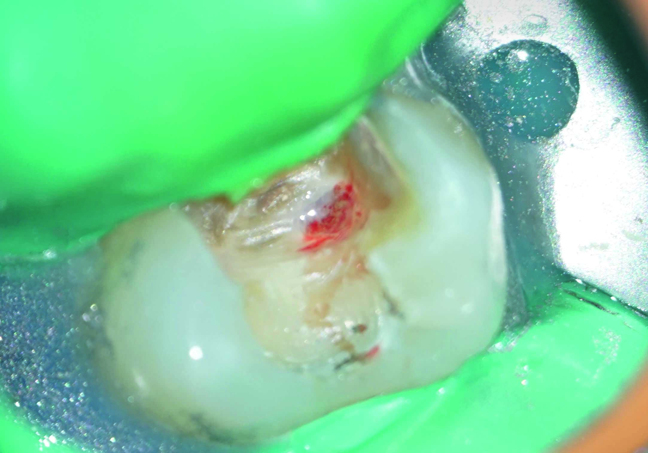 Direct pulp capping as a conservative procedure to maintain pulp vitality