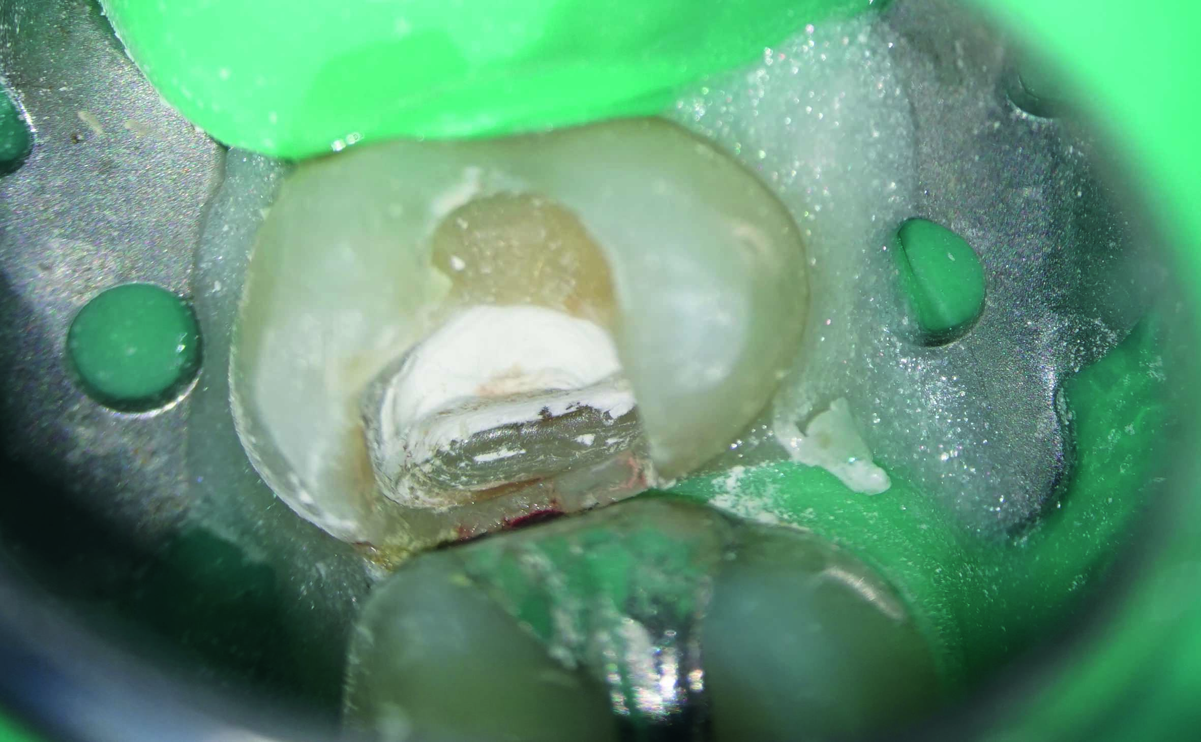 Direct pulp capping as a conservative procedure to maintain pulp vitality