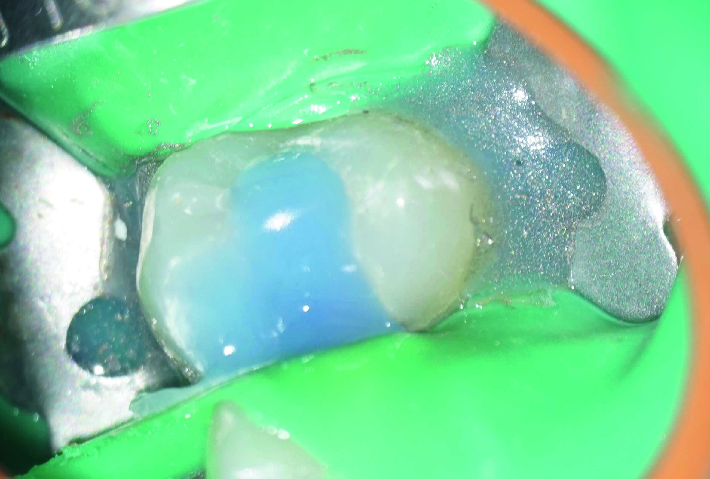 Direct pulp capping as a conservative procedure to maintain pulp vitality