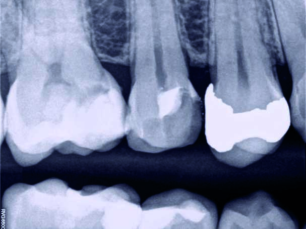 Direct pulp capping as a conservative procedure to maintain pulp vitality
