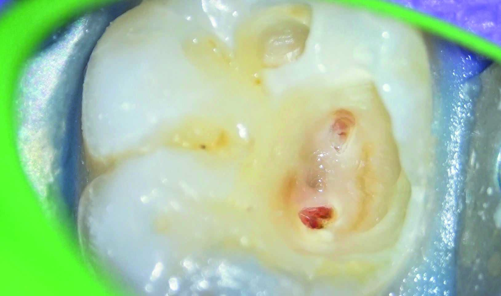 DT News - Germany - Unmittelbare Pulpa-Überkappung als konservatives Verfahren zum Erhalt der ...