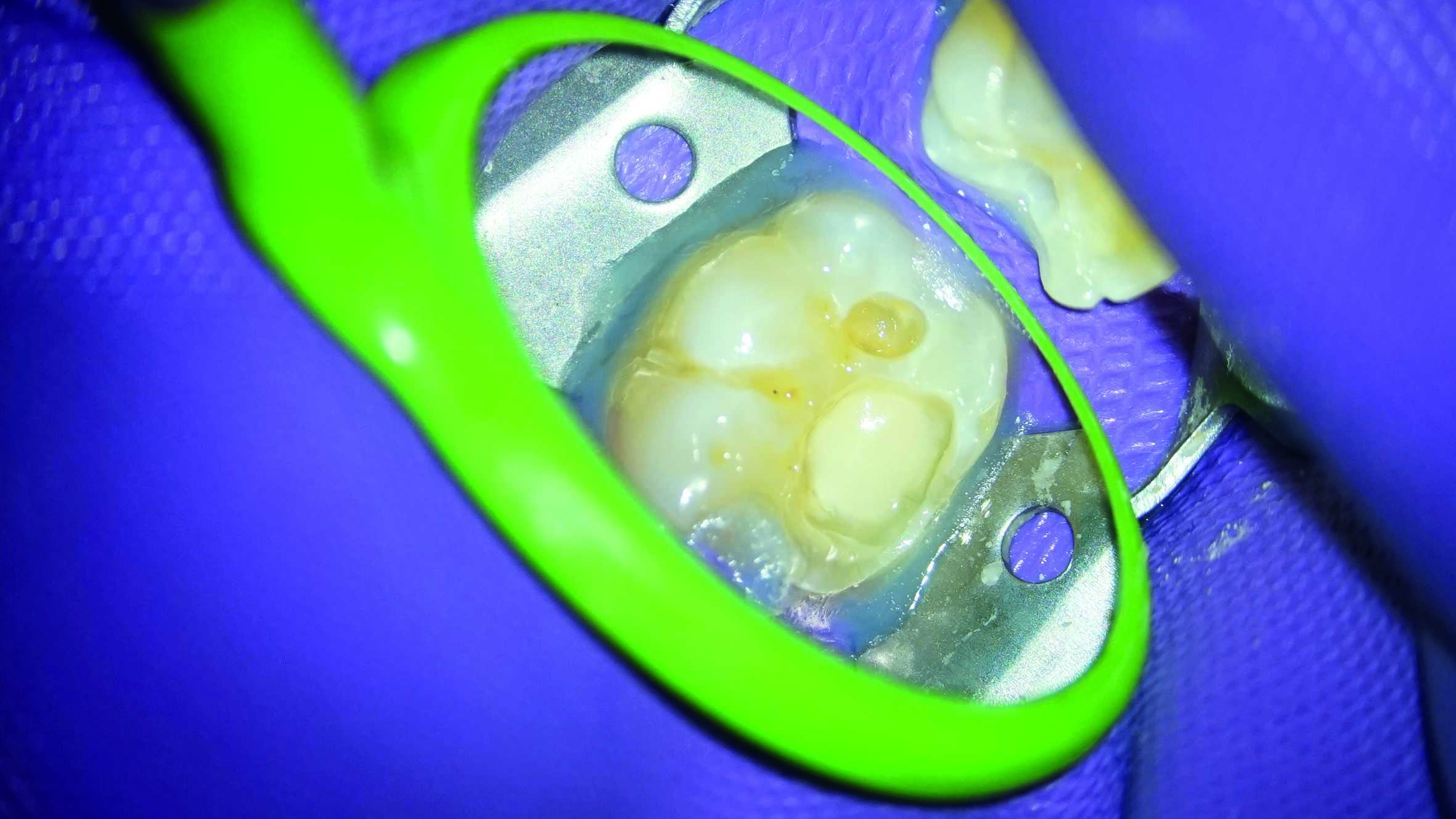 Direct pulp capping as a conservative procedure to maintain pulp vitality