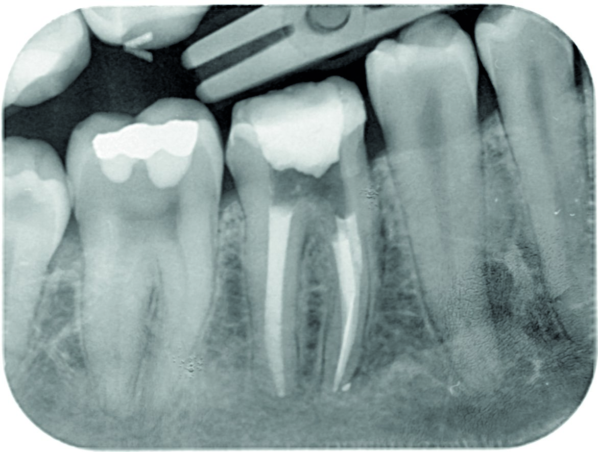 Orthograde apical application of an MTA plug in a tooth without ...