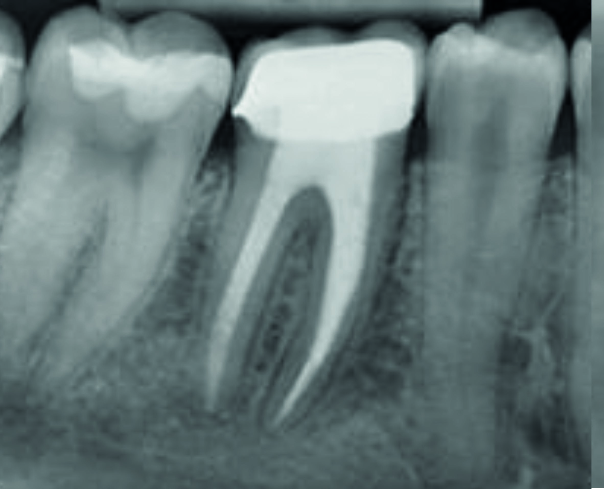 Orthograde apical application of an MTA plug in a tooth without ...