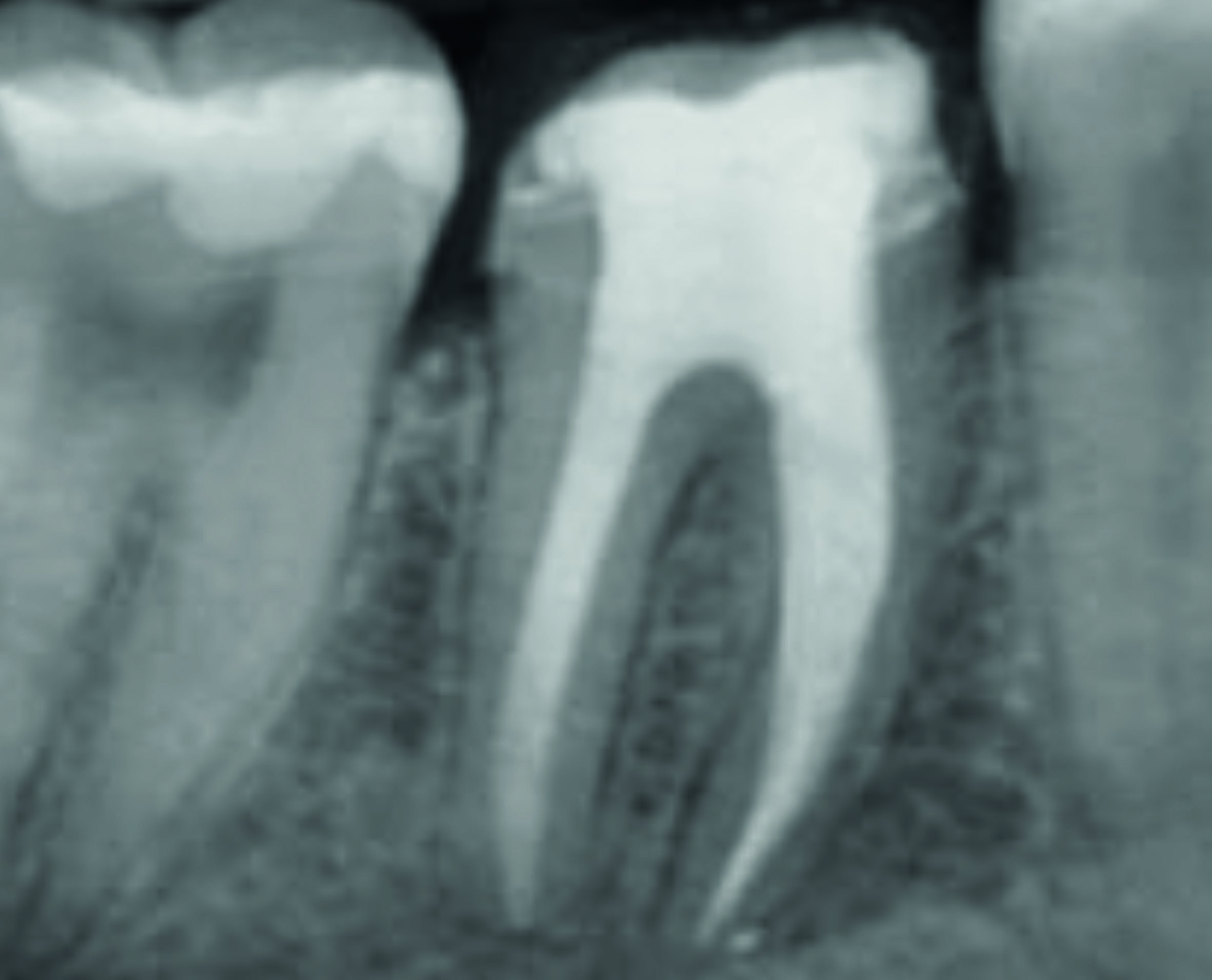 Orthograde apical application of an MTA plug in a tooth without ...