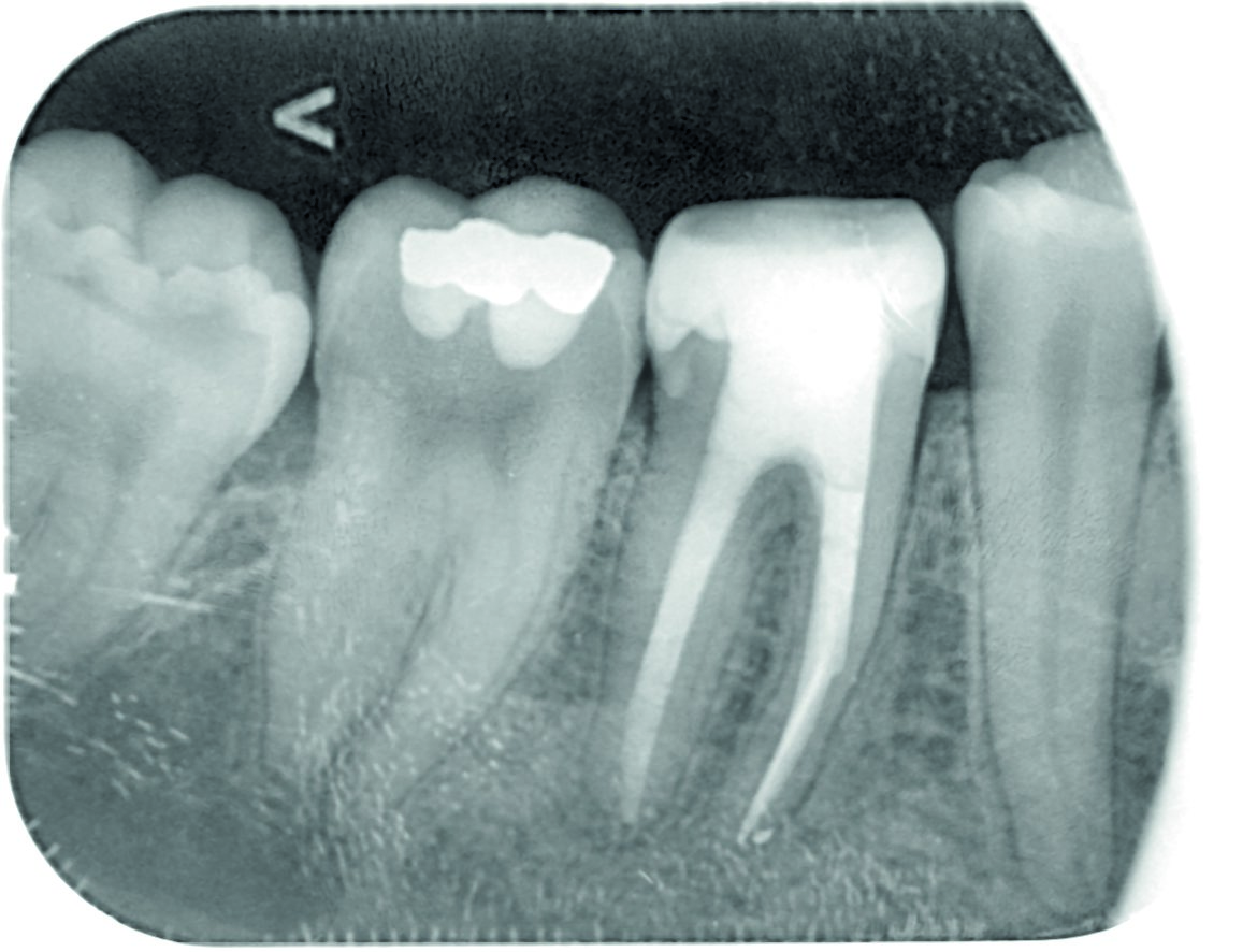 Orthograde apical application of an MTA plug in a tooth without ...