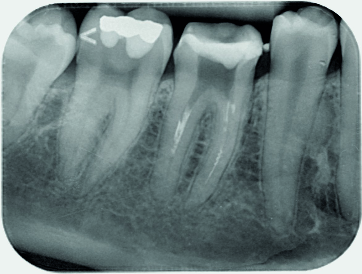 Orthograde apical application of an MTA plug in a tooth without ...