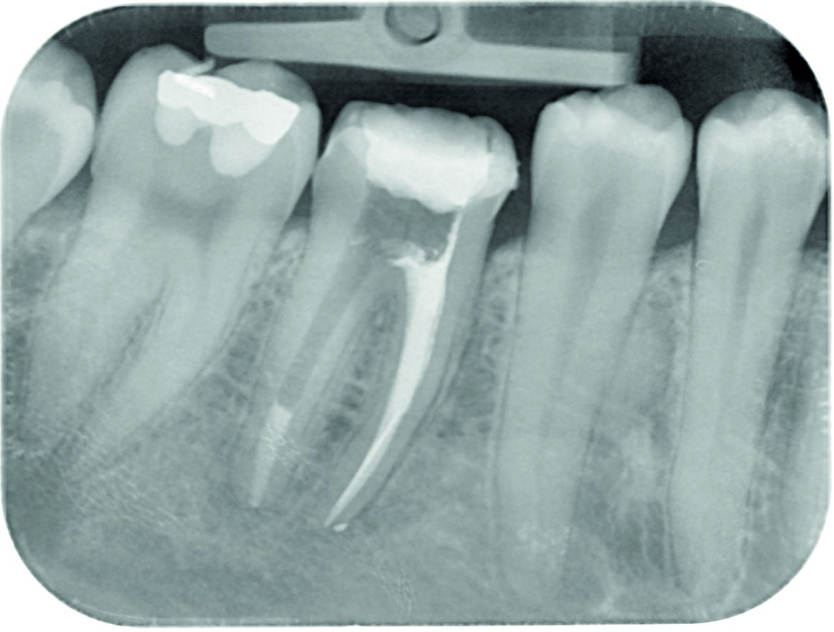 Orthograde apical application of an MTA plug in a tooth without ...