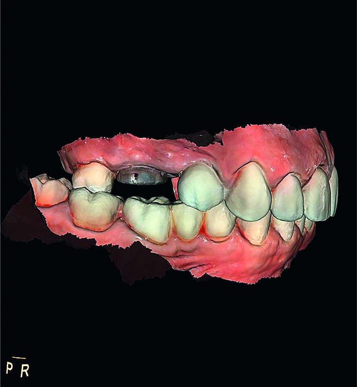 Dental News - Digital workflow and application of PRF and ozone therapy ...