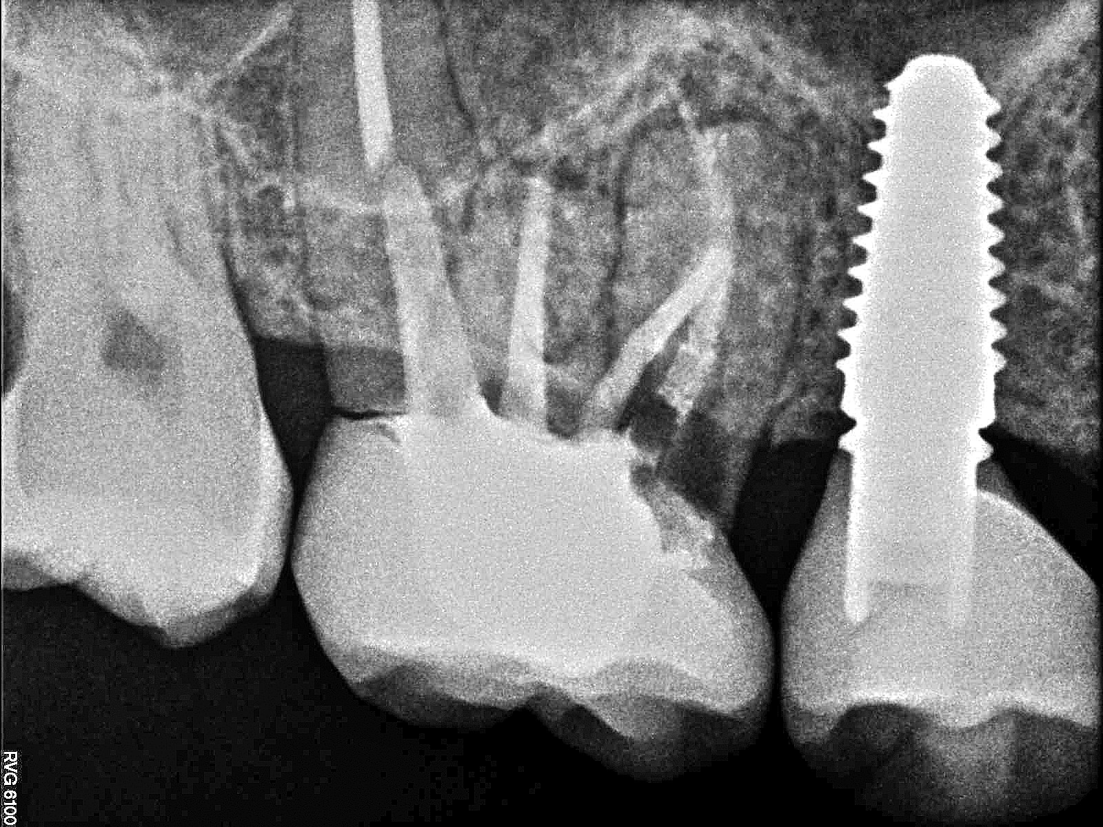 Dental News - Digital workflow and application of PRF and ozone therapy ...