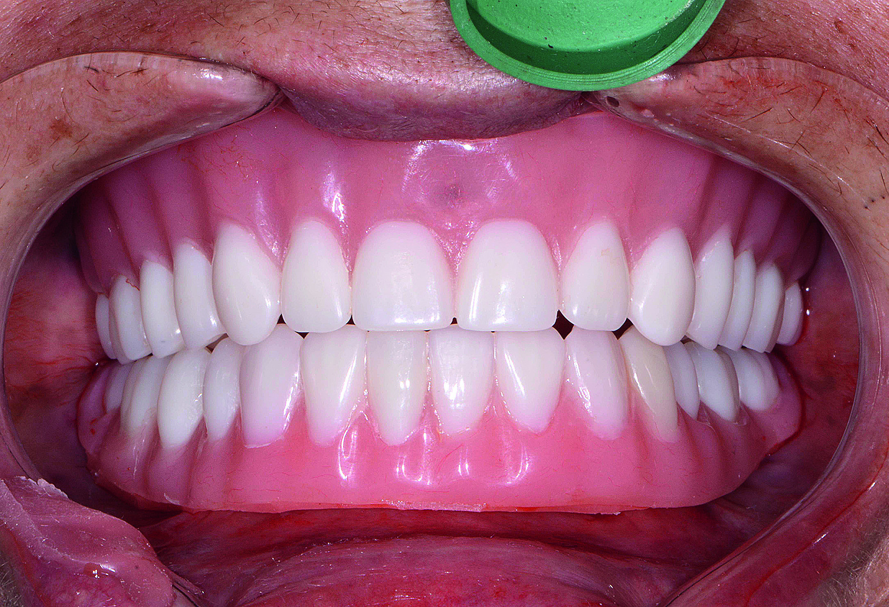 Dental News - Incorporating CAD/CAM solutions for full-mouth dental ...