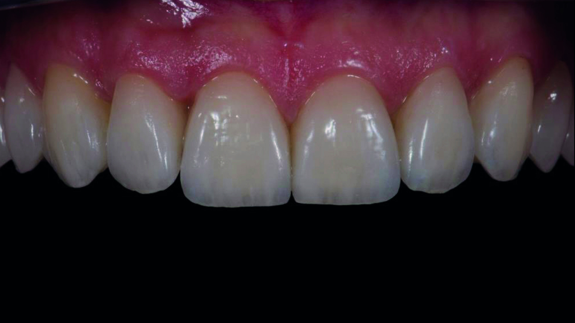 Dental News - Digital vs. analogue workflow on ten ceramic veneers in ...