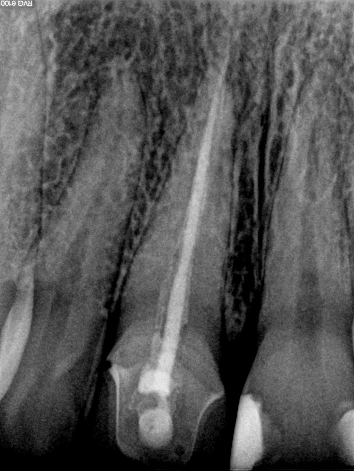 Dental News - Apical lesions: To treat or not to treat?