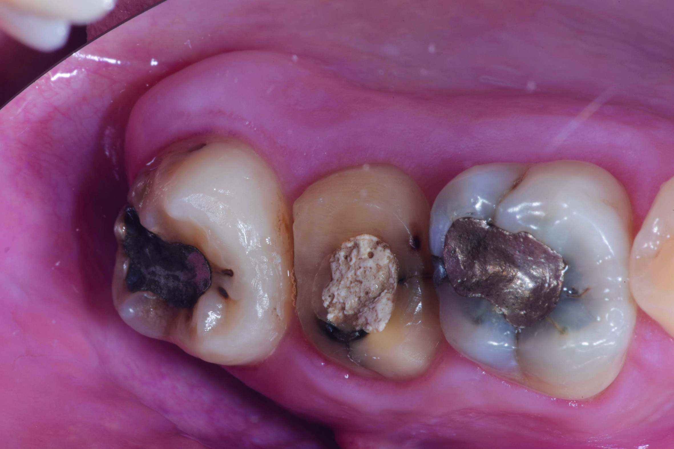 Dental News - How to give a second life to third molars: A case series ...