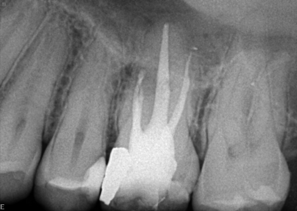 Dental News - Maxillary sinus and root canal therapy complications