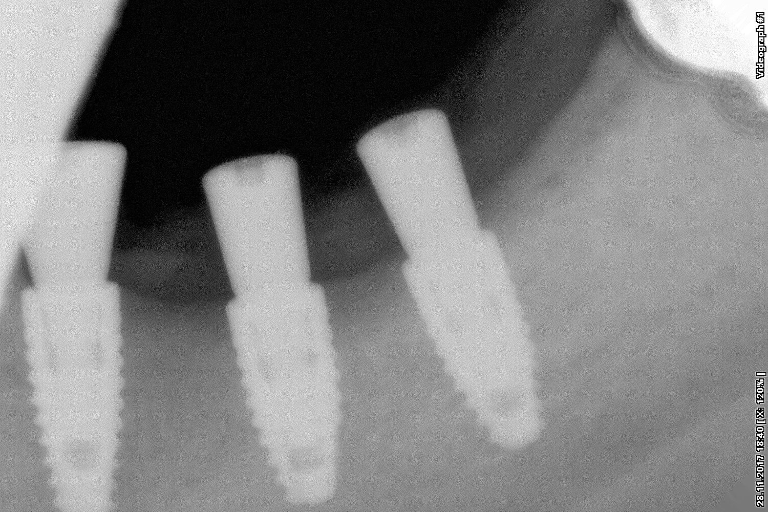 Dental News - Guided bone regeneration in smokers - Use of synthetic ...