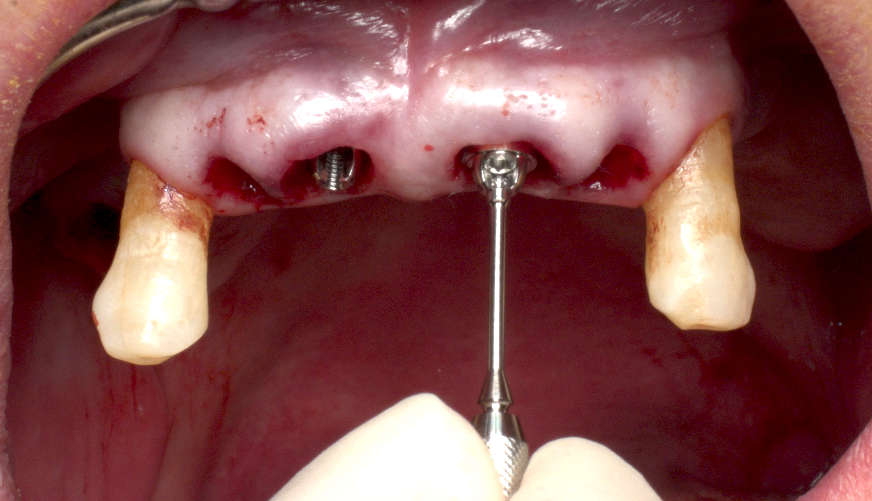 Dental News - The fully digital Pro Arch protocol
