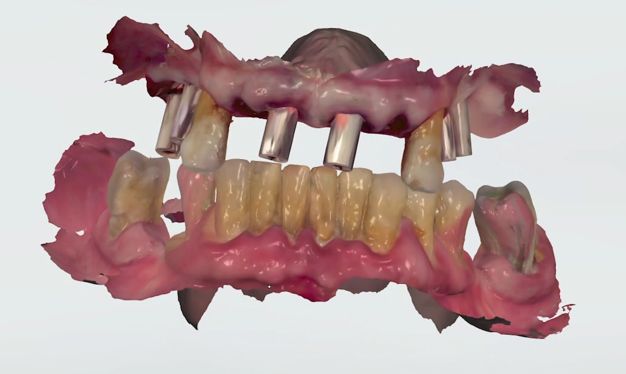 Dental News - The fully digital Pro Arch protocol