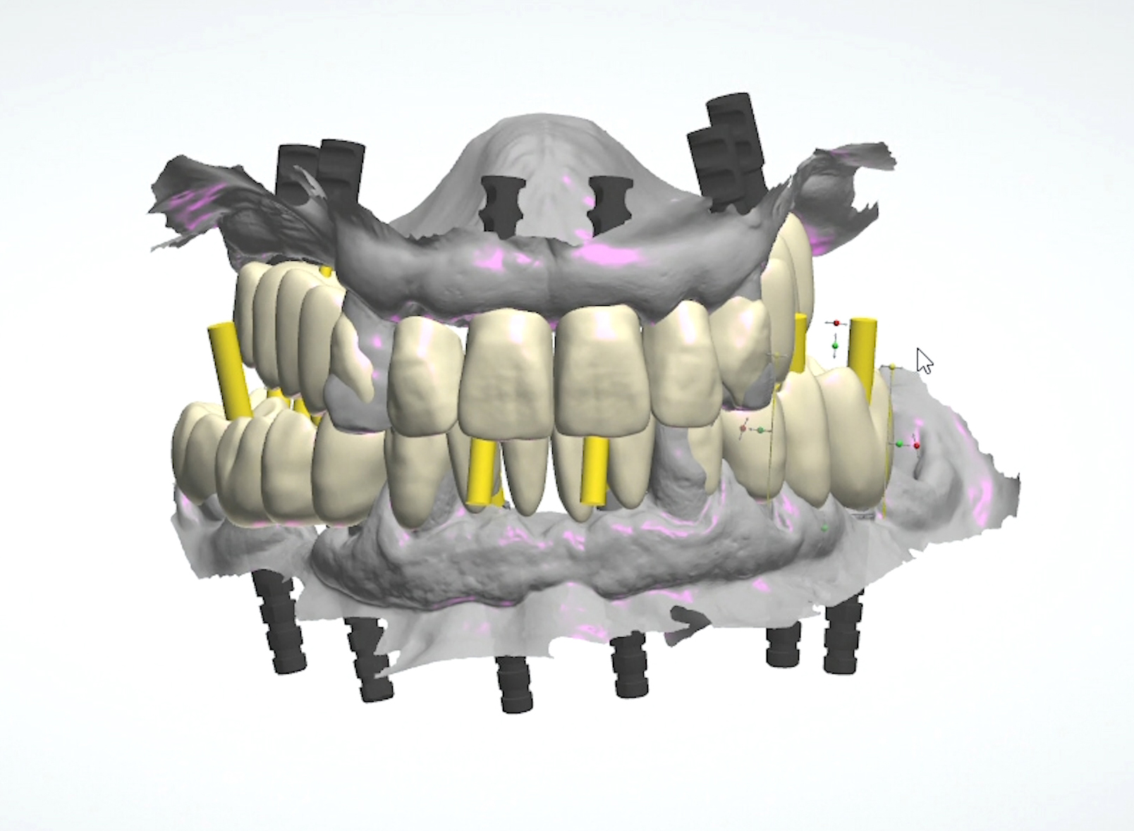 Dental News - The fully digital Pro Arch protocol