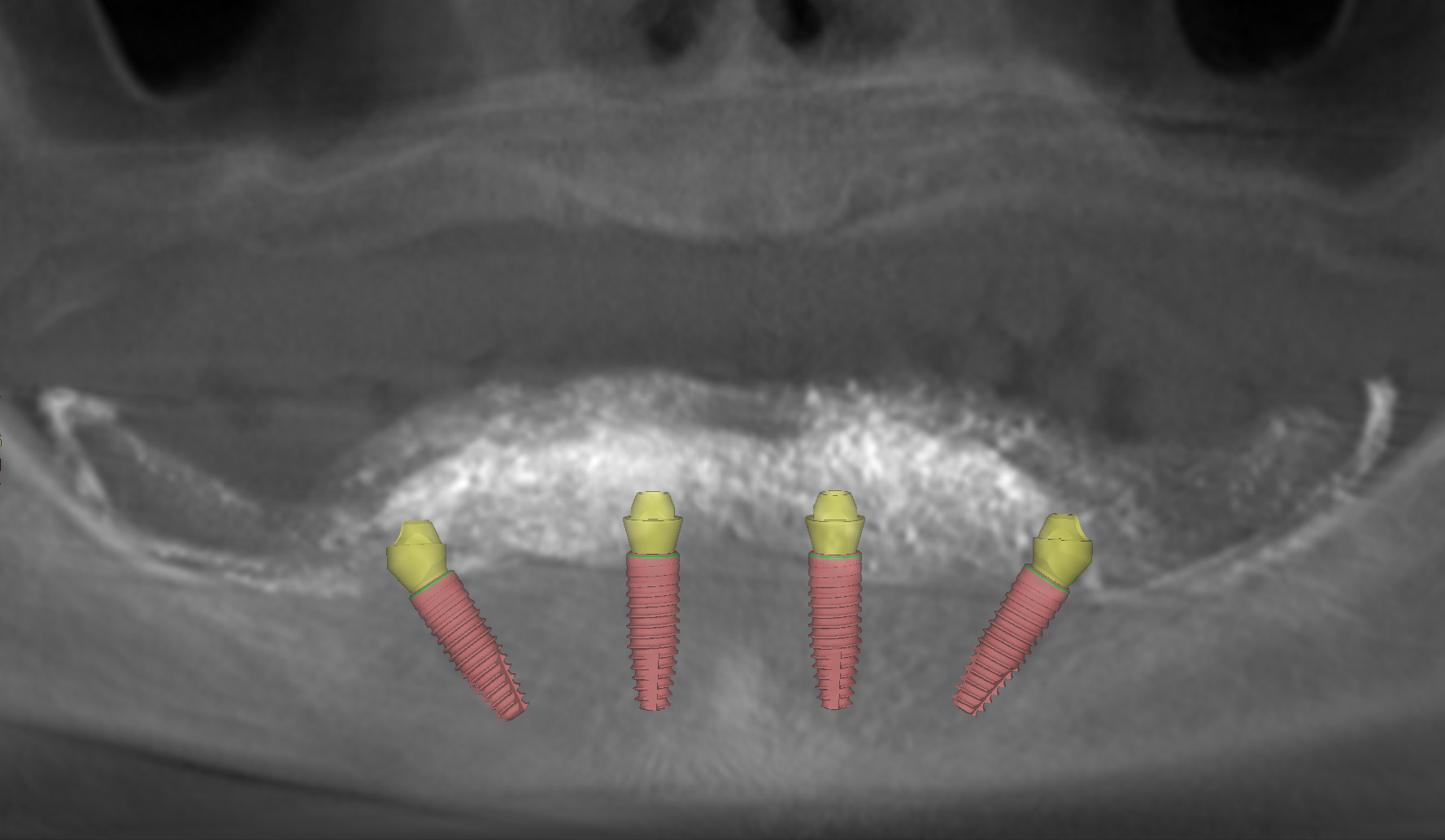 Dental News - Straumann Pro Arch concept with fully guided implant and ...