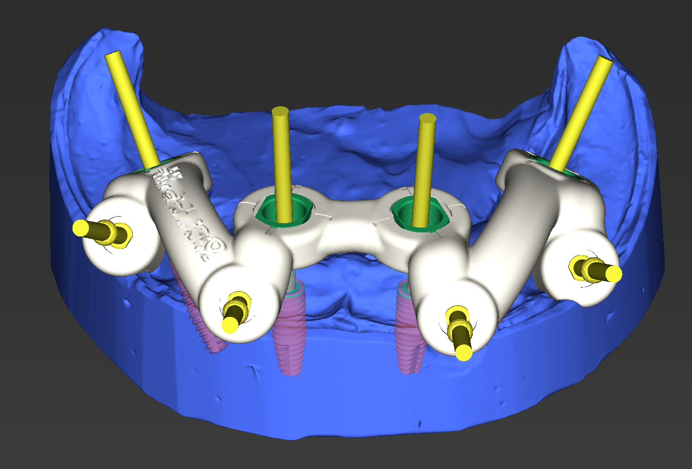 Dental News - Straumann Pro Arch concept with fully guided implant and ...