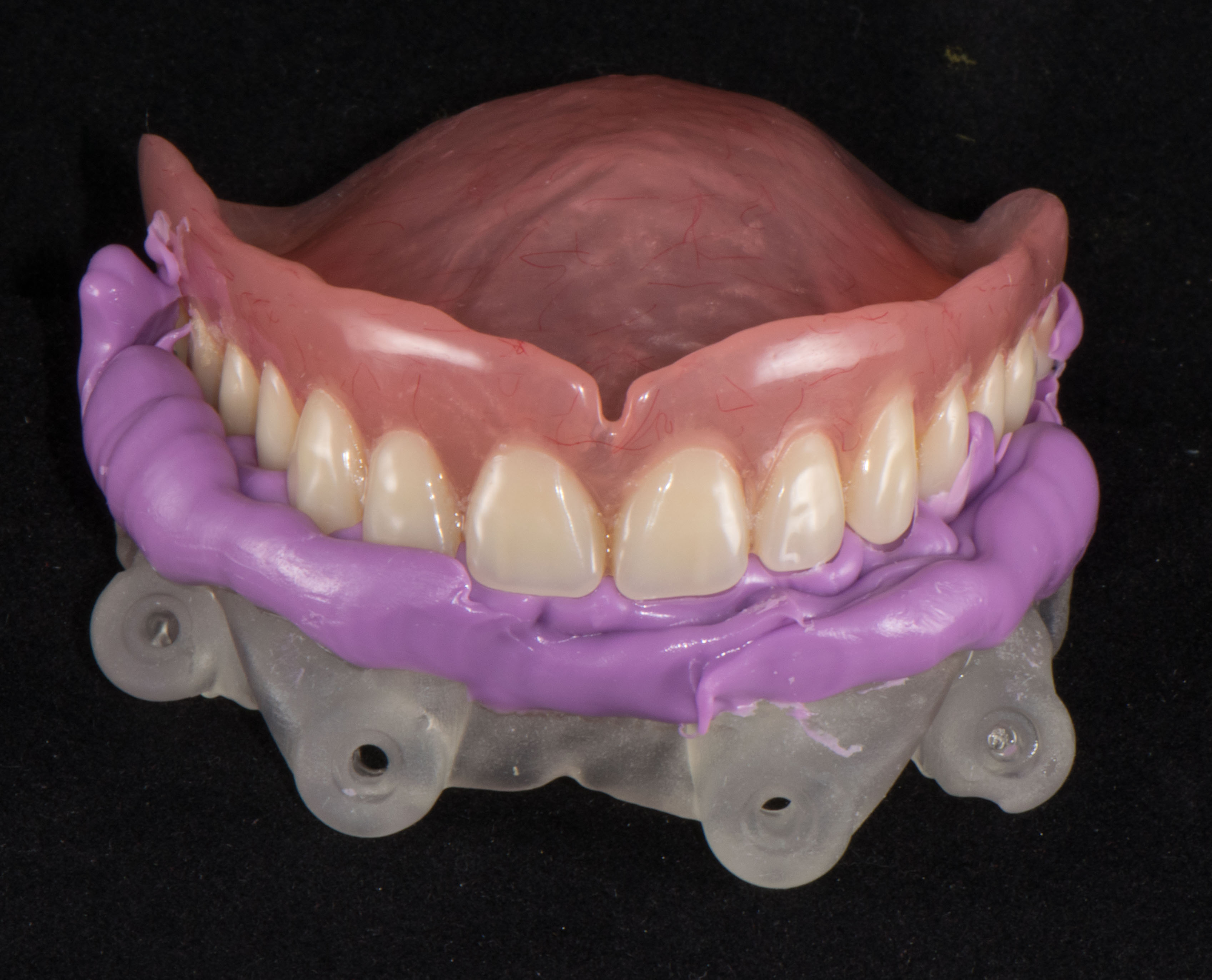 Dental News - Straumann Pro Arch concept with fully guided implant and ...