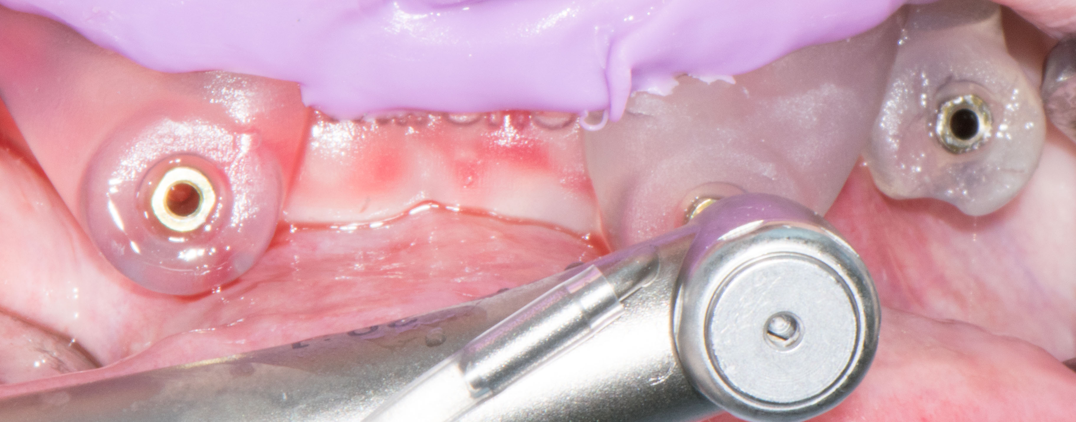 Dental News - Straumann Pro Arch concept with fully guided implant and ...