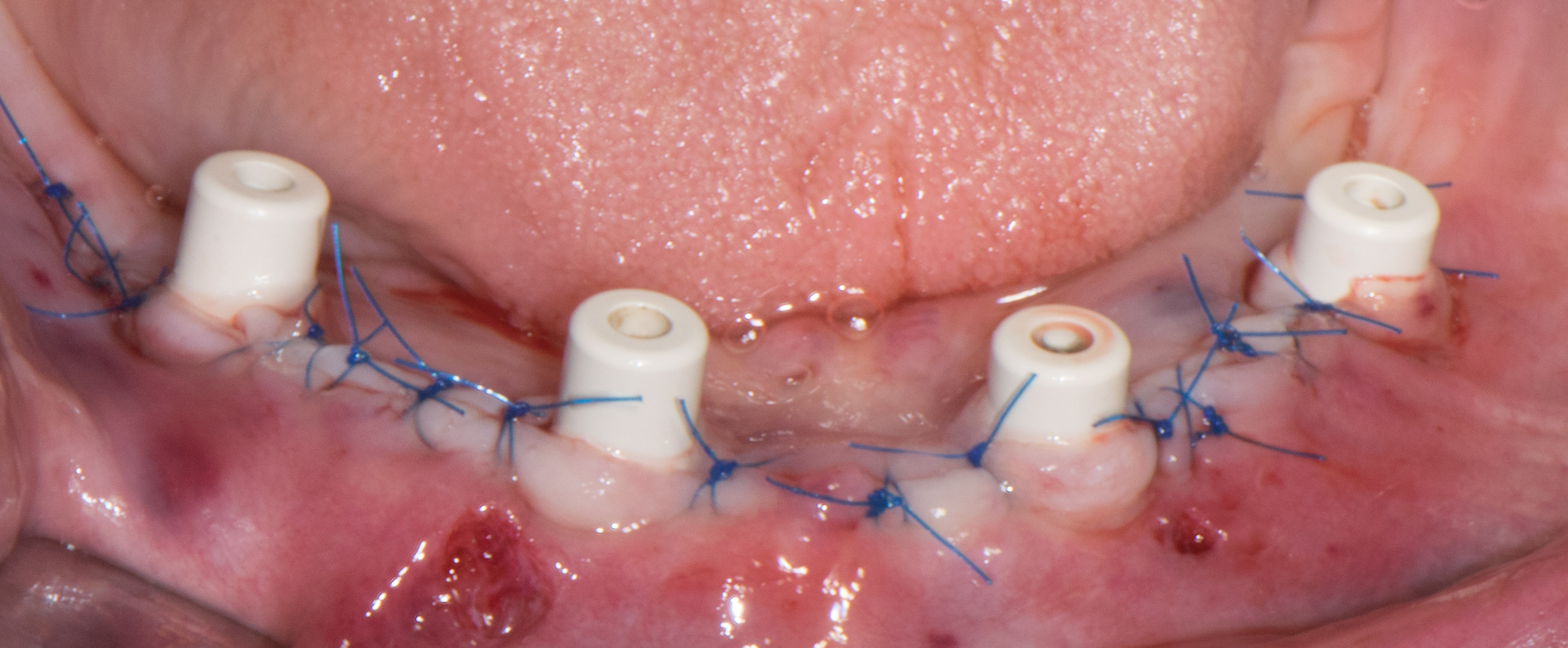 Dental News - Straumann Pro Arch concept with fully guided implant and ...