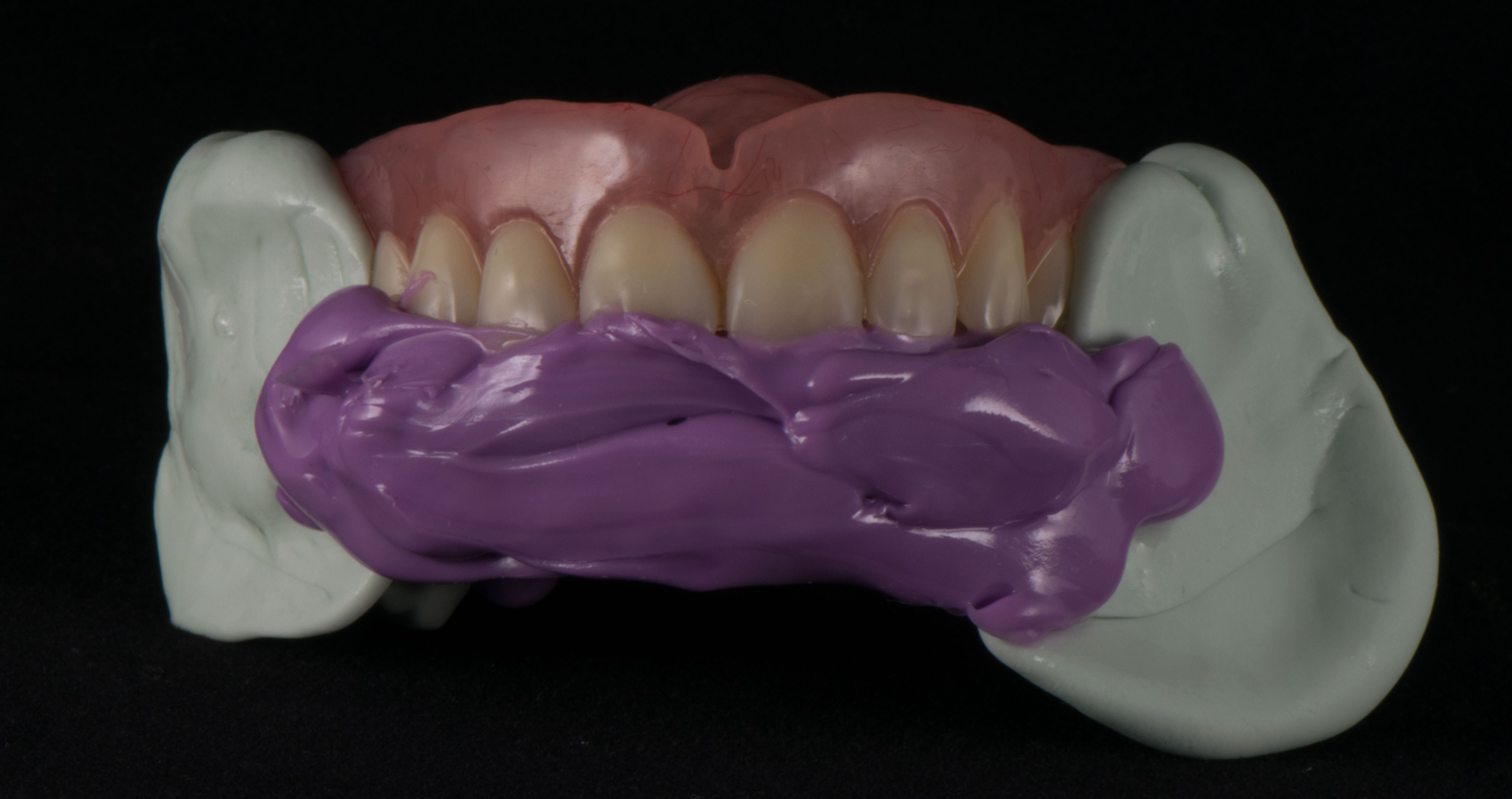 Dental News - Straumann Pro Arch concept with fully guided implant and ...