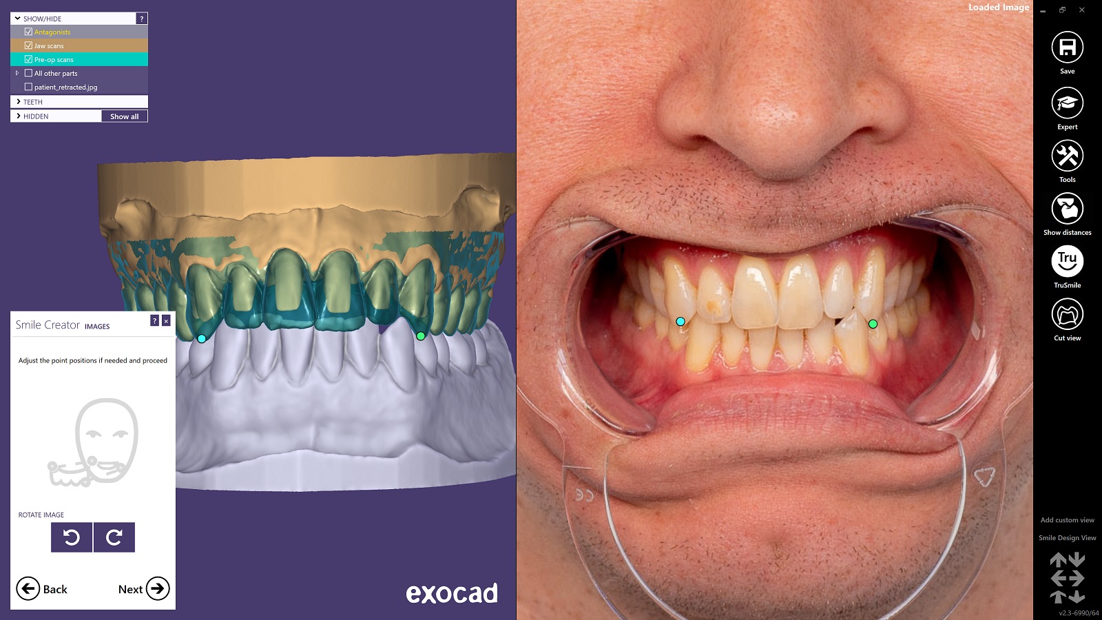 exocad – Smile Creator