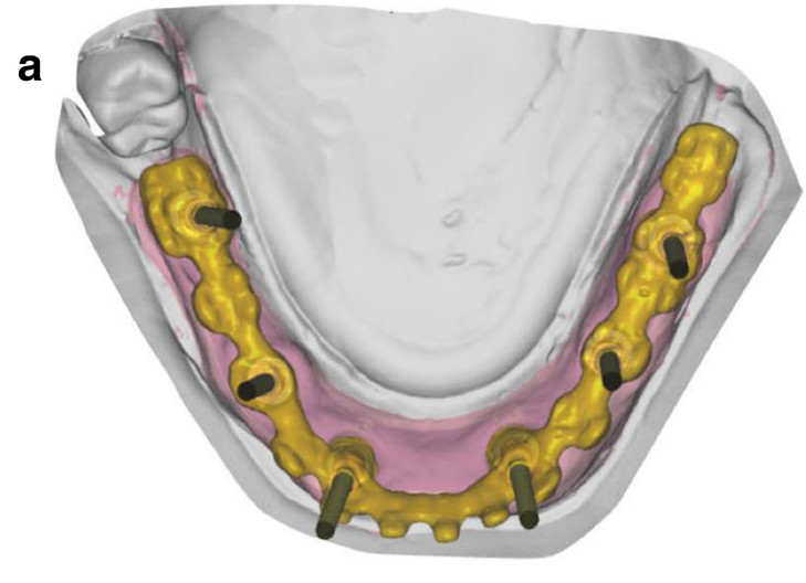 Dental News - Computer-aided, template-guided immediate implant ...