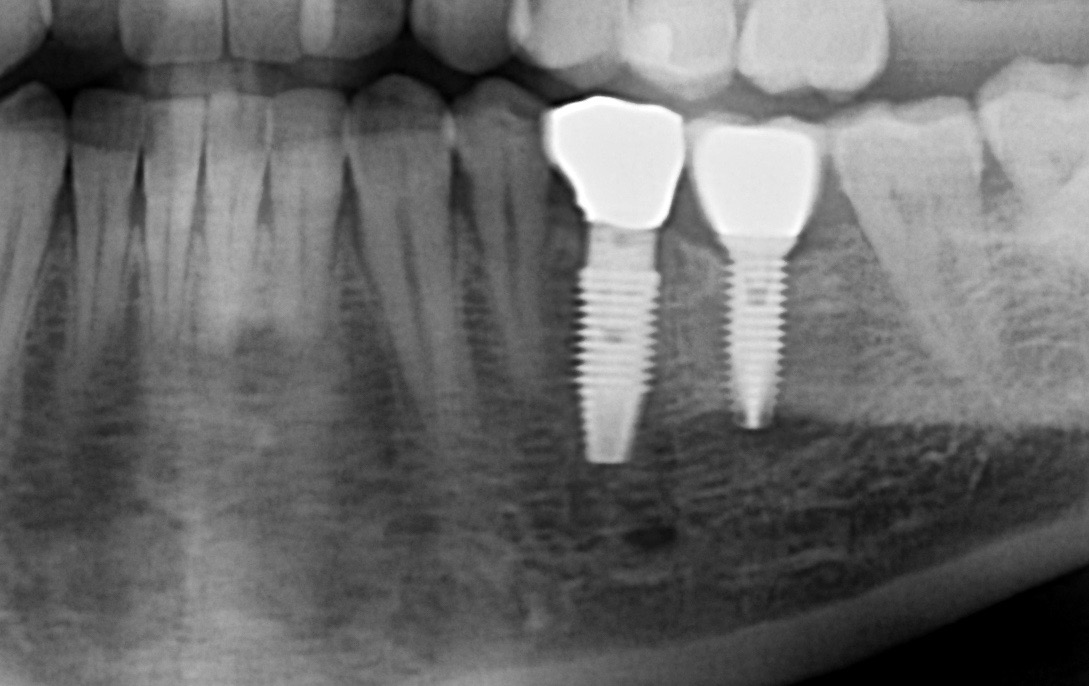 Dental News - Immediate loading of a socket shield post-extraction ...