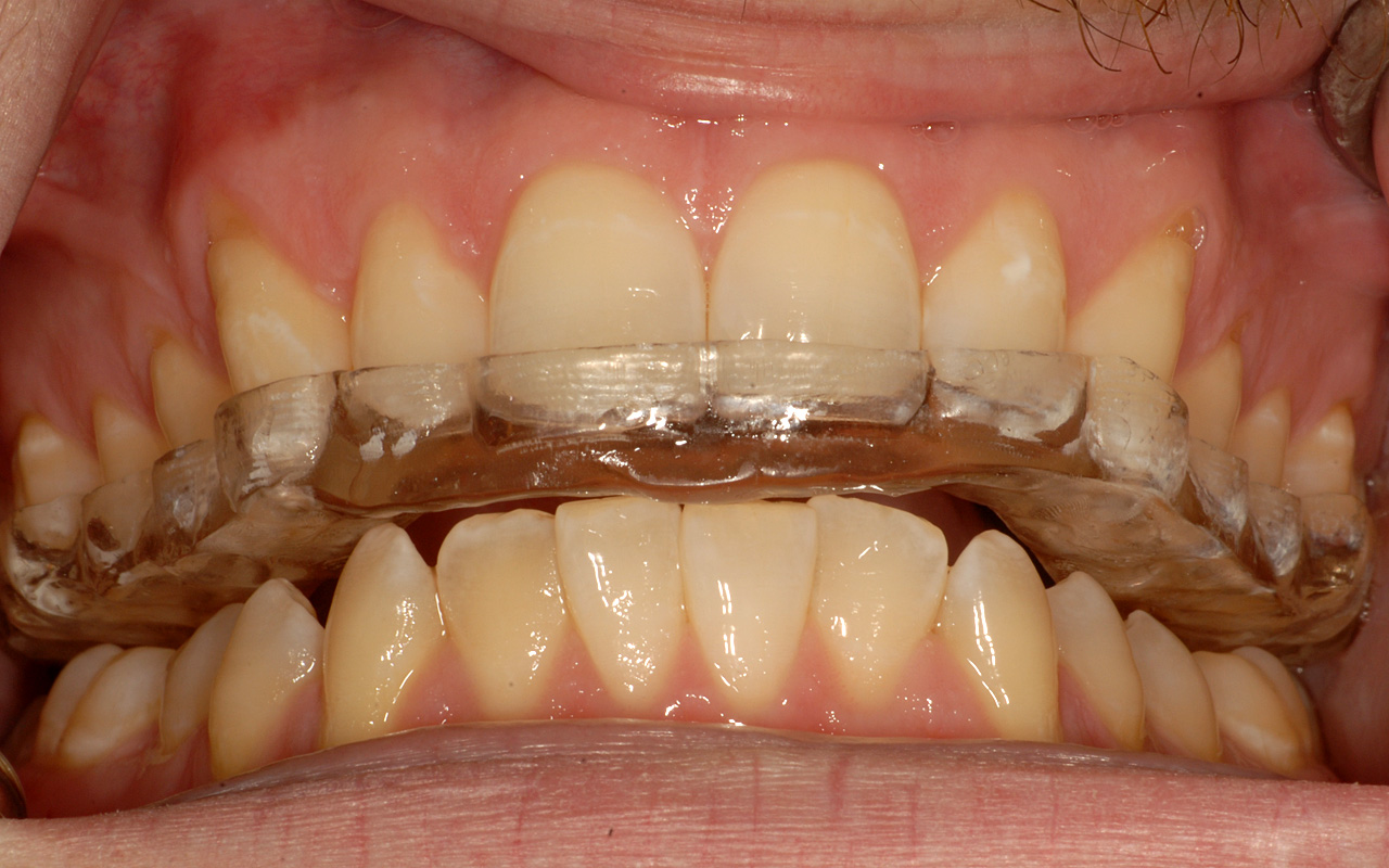 DT News - Nordic - Occlusion principles for the practising dentist in ...