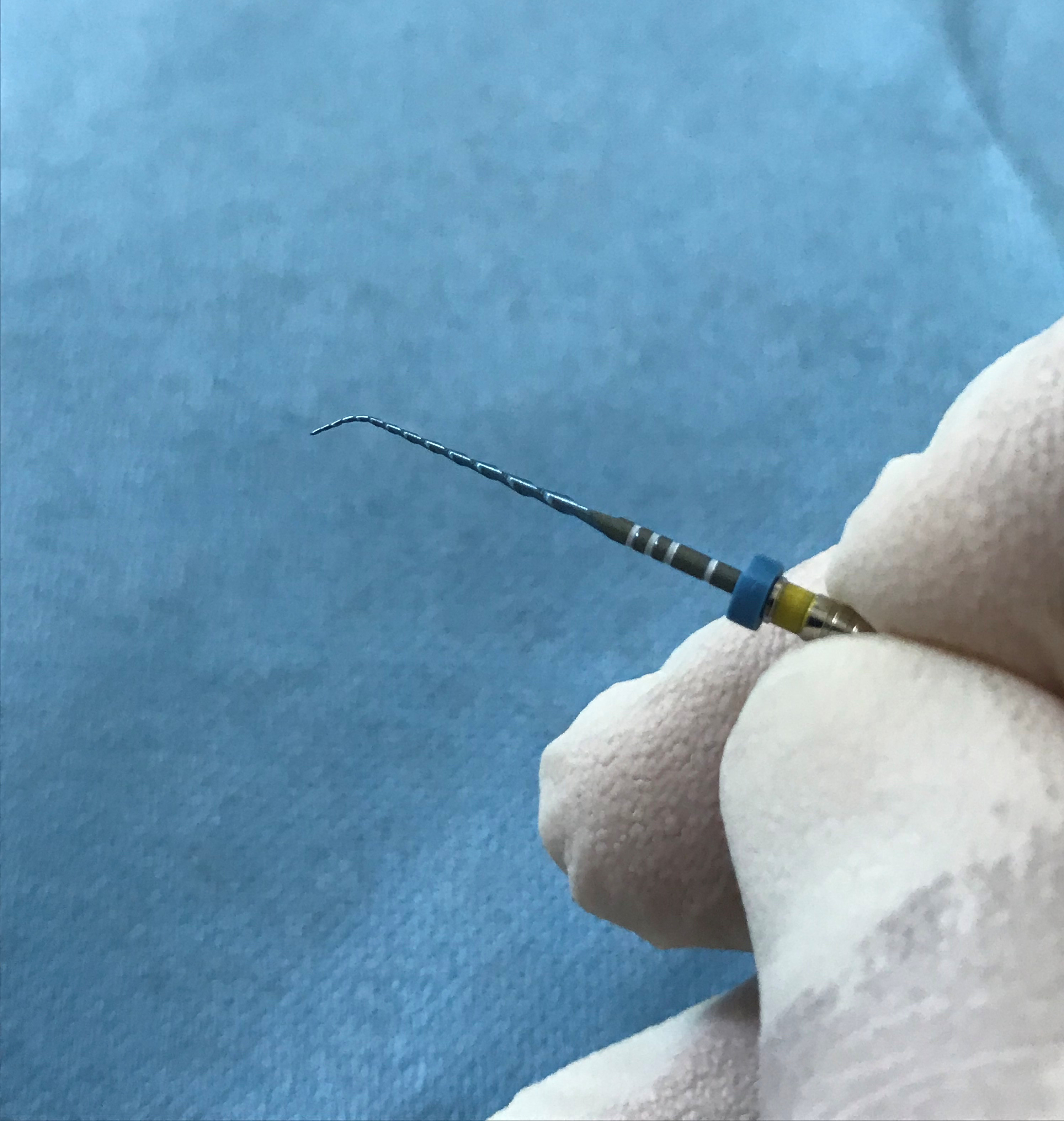 Shaping a Type V mandibular premolar with VDW.ROTATE