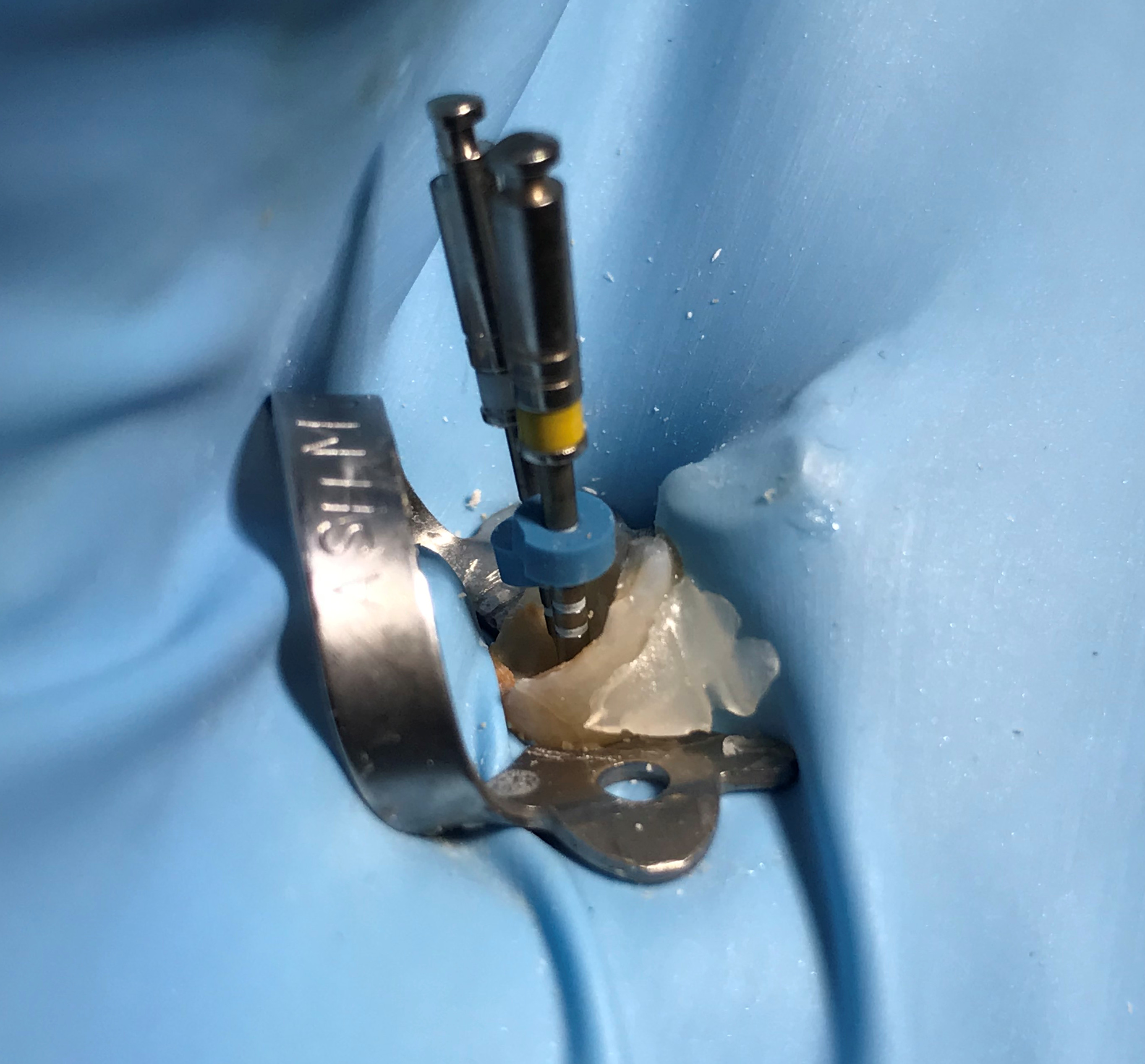 Shaping a Type V mandibular premolar with VDW.ROTATE