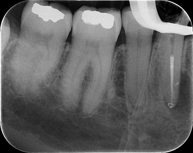 Shaping a Type V mandibular premolar with VDW.ROTATE
