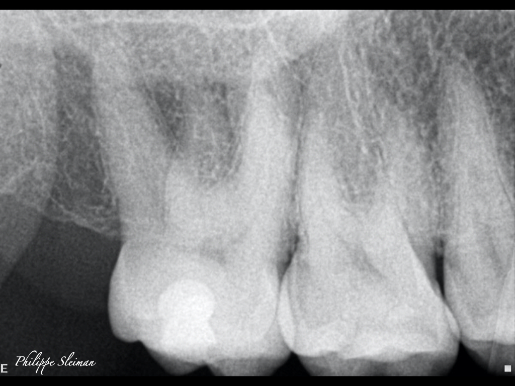 Dental News - Clinical management of maxillary second molar root canal ...