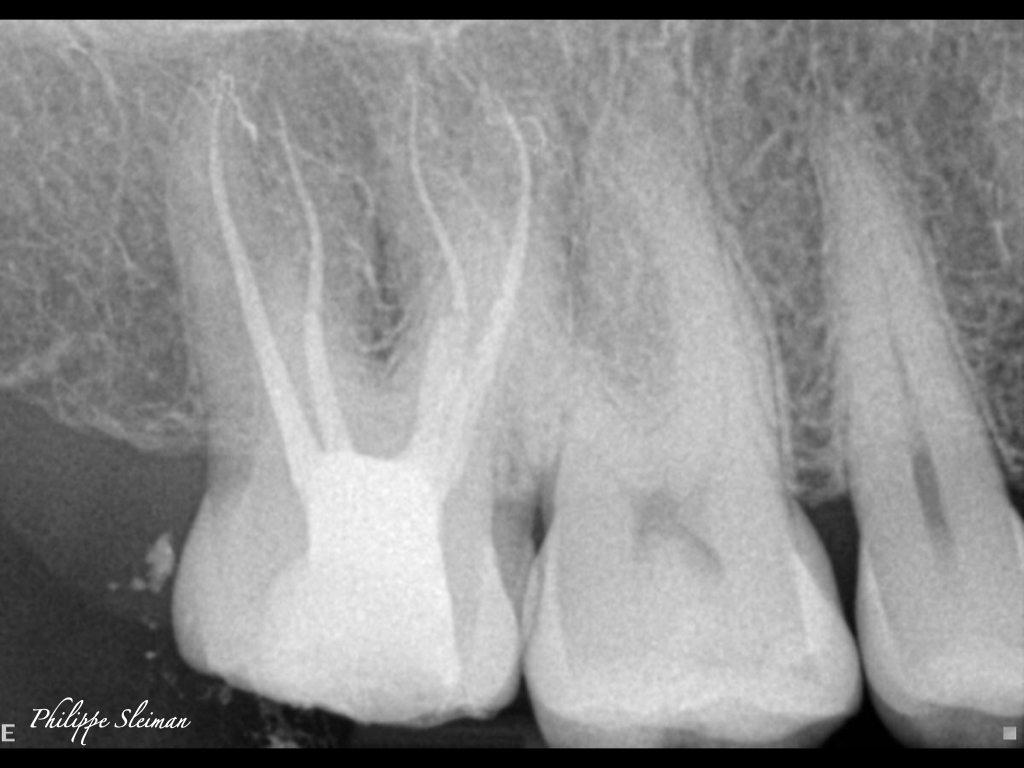 Dental News - Clinical management of maxillary second molar root canal ...